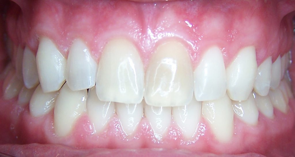 Invisalign - Sherwood Dental