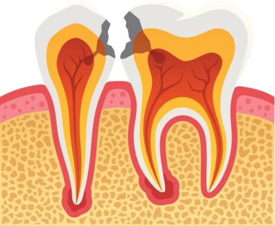 Tooth Abscess: Signs, Symptoms, and Causes | Oral Care